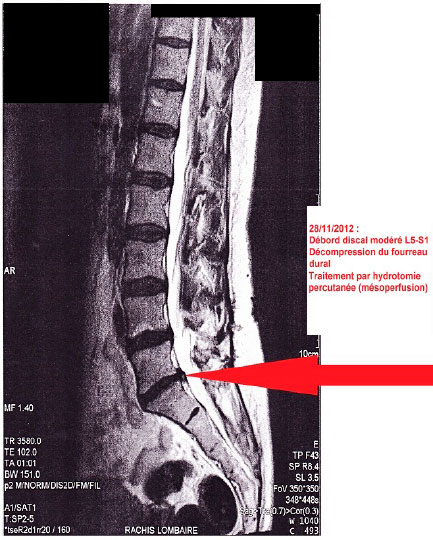 Résultats en photos ┃ Association Internationale d'Hydrotomie Percutanée